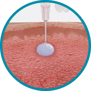 ELIGARD® (Leuprolide Acetate)